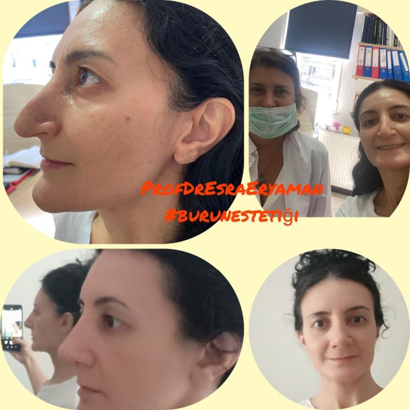 Professor Esra Eryaman | The nasolabial angle and columella-lobular angle