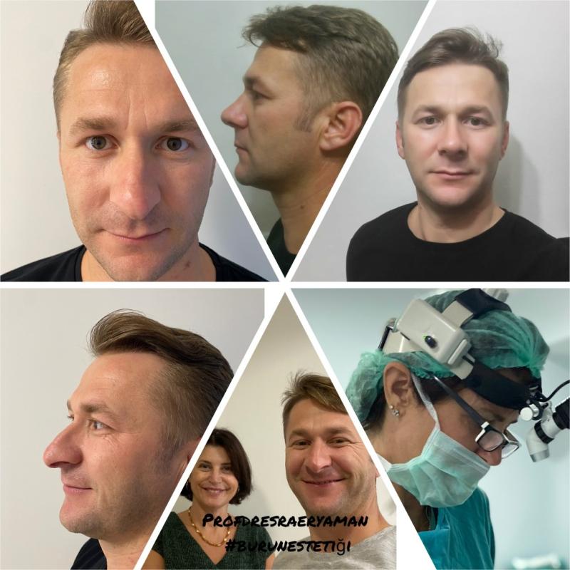 Professor Esra Eryaman M.D | The nasolabial angle and columella-lobular ...