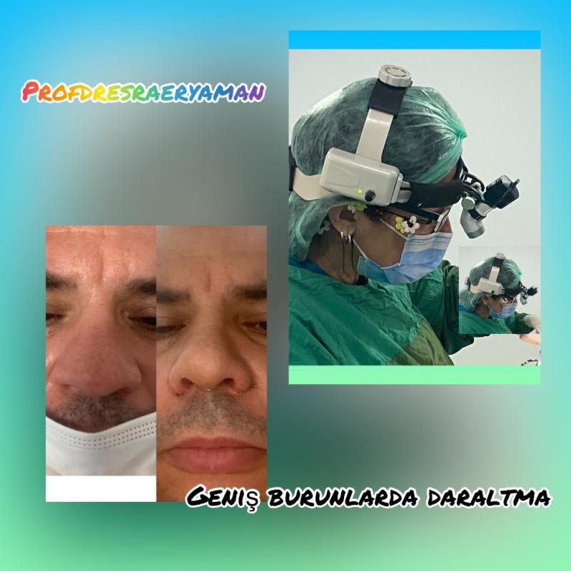 Professor Esra Eryaman | The nasolabial angle and columella-lobular angle